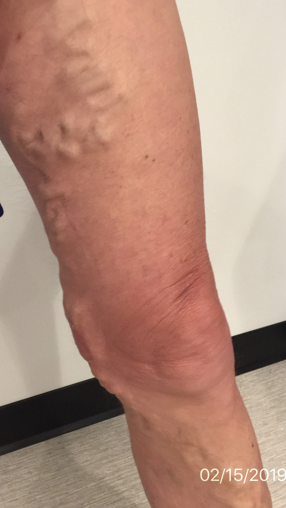 Before & After Photos - Vanish Advanced Vein Treatments