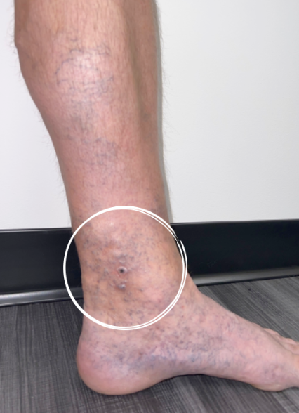 Vein Complications - Vanish Advanced Vein Treatments