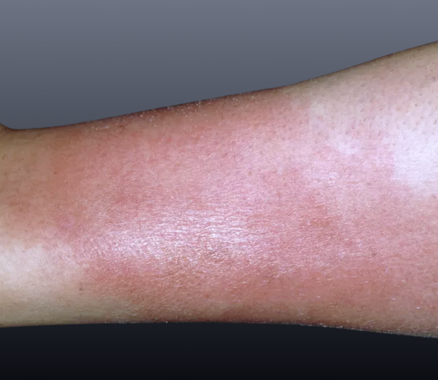 Vein Complications - Vanish Advanced Vein Treatments