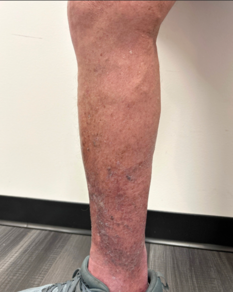 Skin Discoloration & Thickening - Vanish Advanced Vein Treatments